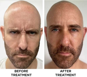 Botox in Bali - Cocoon Medical Spa